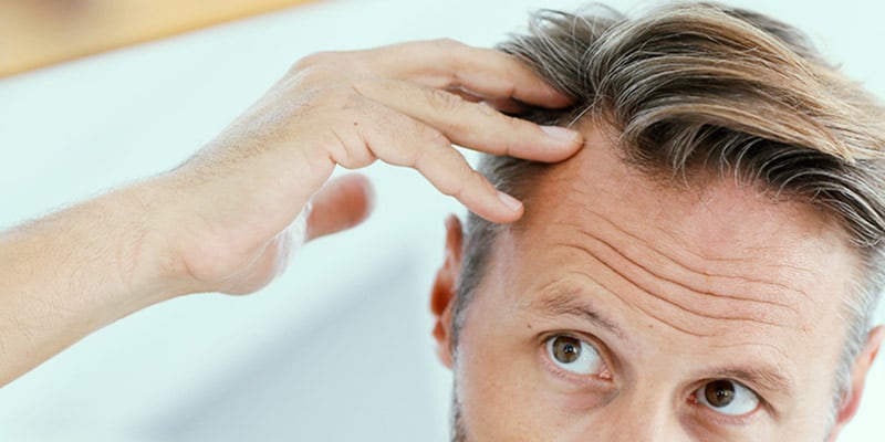 Como disfarçar a careca? 3 dicas de estilo [+ BÔNUS]